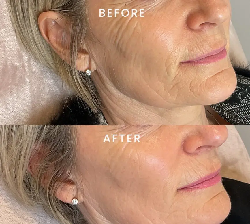 5 Brands of The Best Fillers For Face - Filled hyaluronic acid factory