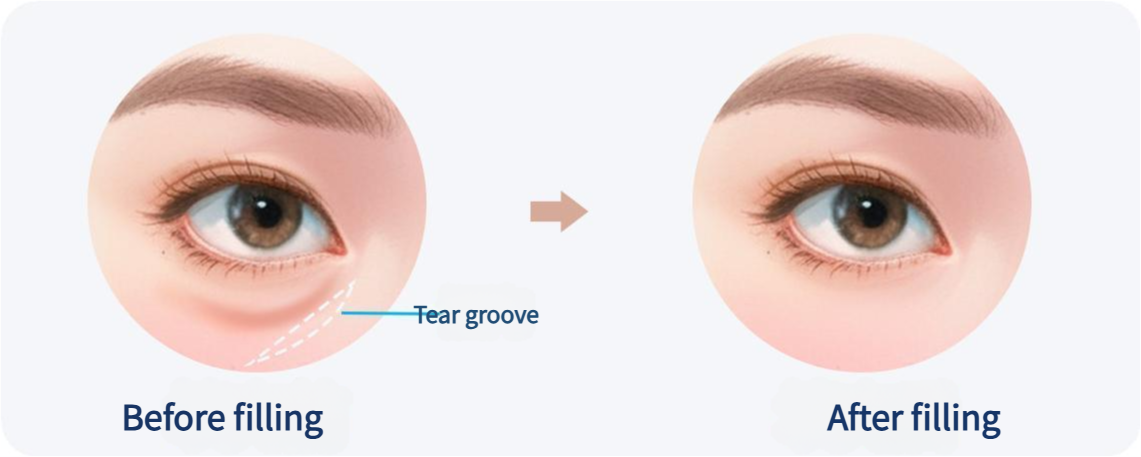 Under Eye Trough Filler: You Need to Know About Restoring Youthful Eyes